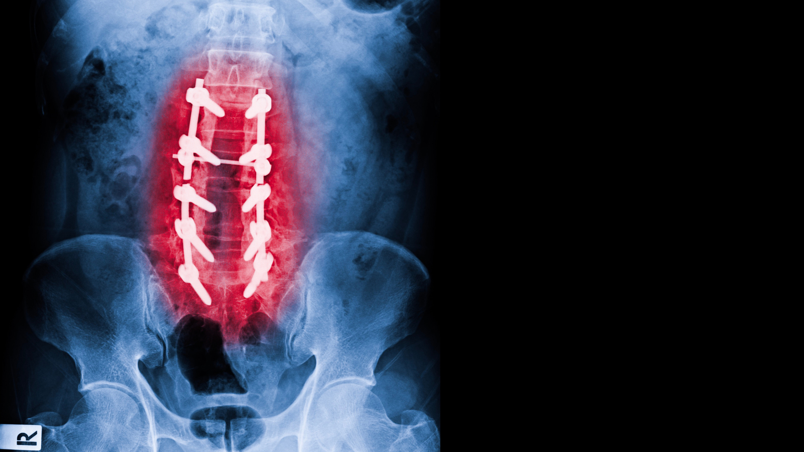 Back surgeon in Illinois | Spinal Fusion Surgery | The Orthopaedic ...